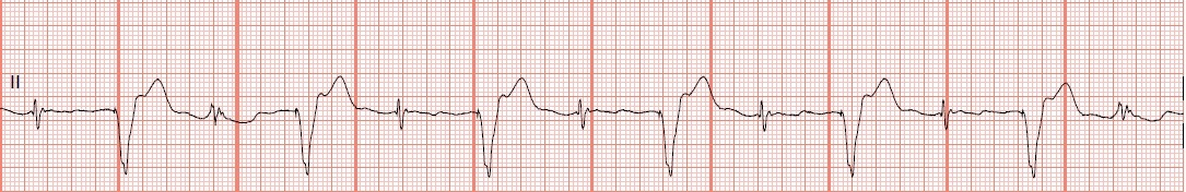 EKG Rhythm Strips 63