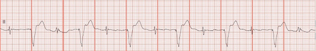 EKG Rhythm Strips 63