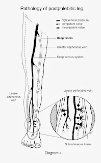 Removal of GSV and LSV of a moderate level distance runner with venous ...