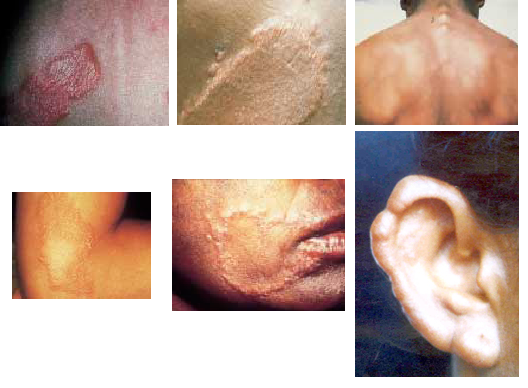 Doenças Infecciosas: Hanseníase