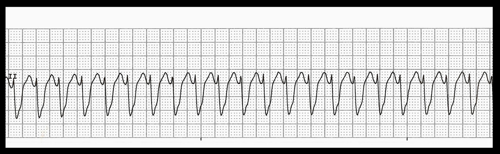 Float Nurse: Practice EKG Strips 329