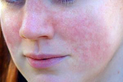 Secret of Health: What Is a Butterfly Rash