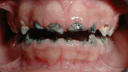 Estomatologia Integral "Hablemos entre dientes": La caries rampante o ...