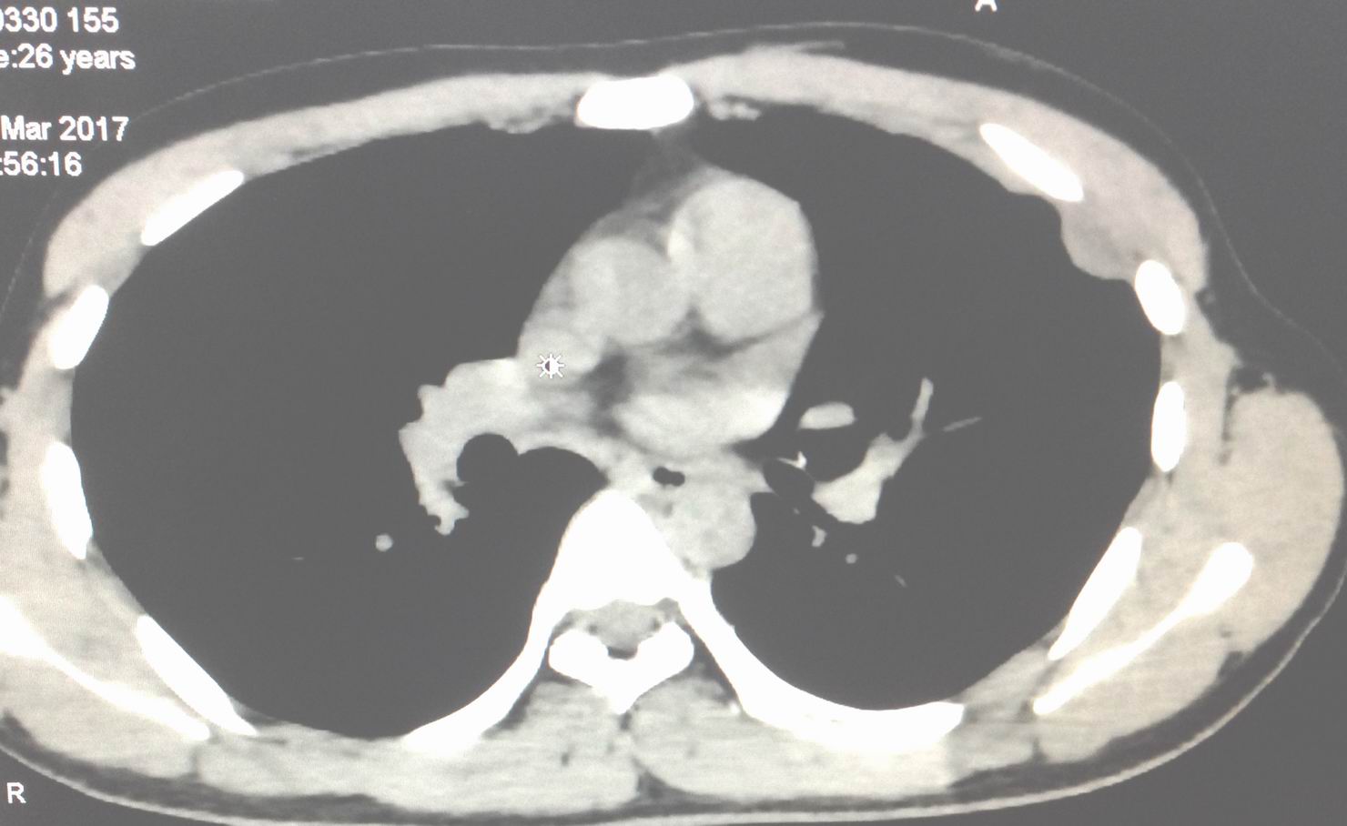 VIETNAMESE MEDIC ULTRASOUND: CASE 426: MULTIPLE TUBERCULOSIS ABSCESSES ...