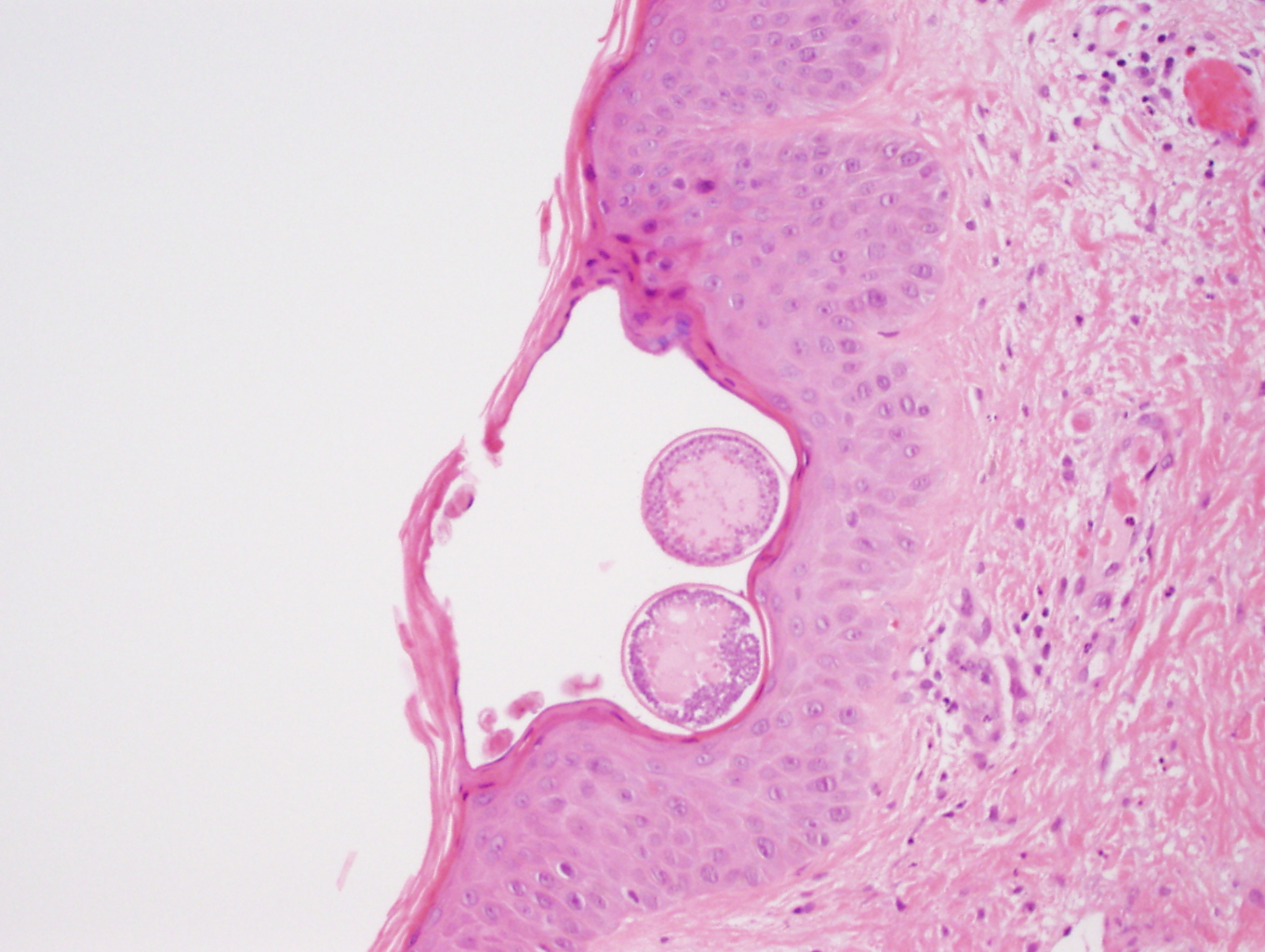 Cutaneous Larva Migrans Histology
