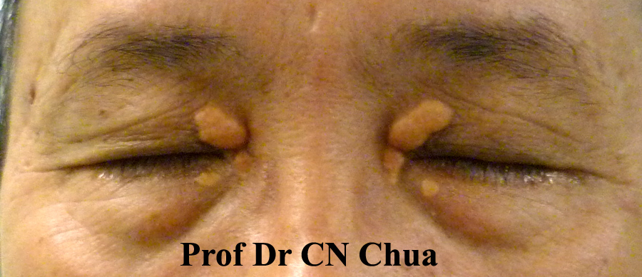Eyelid Surgery By Prof Dr CN CHUA Doc Why Do I Get These eyelid-surgery-by-prof-dr-cn-chua-doc-why-do-i-get-these