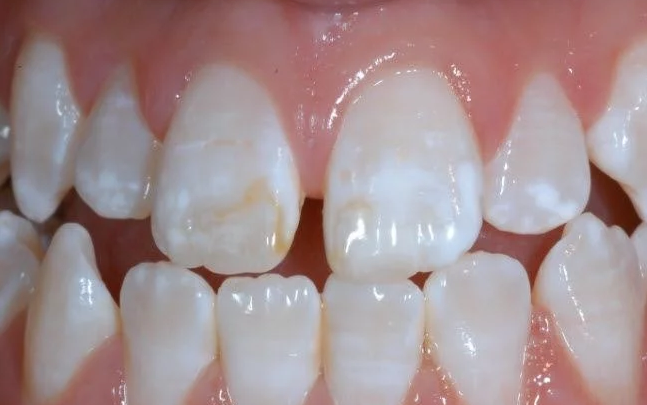 DENTAL CARE 3: What is Fluorosis?