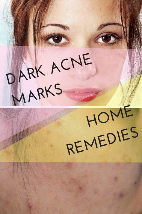 How to Get Rid Of Redness From Acne And Pimples