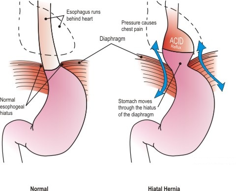 Hiatus Hernia: Signs & Symptoms of a Hiatus Hernia