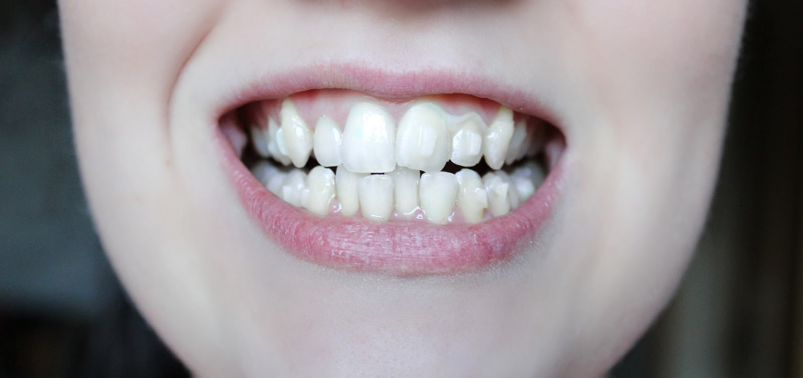 makeupbysaz: Invisalign: 7 weeks into treatment (Tray 1-3 )