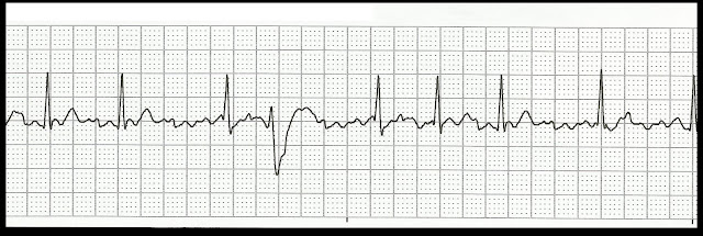 Basic ECG Rhythm Test 03