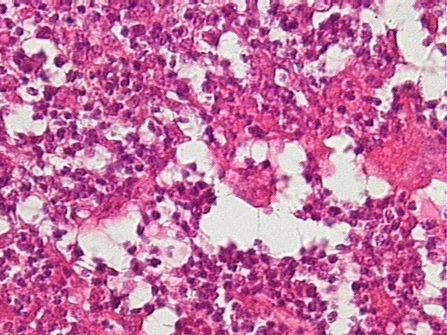 Imagen de un absceso