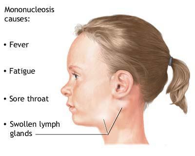 Juwita Blog: Mononucleosis Symptoms Signs