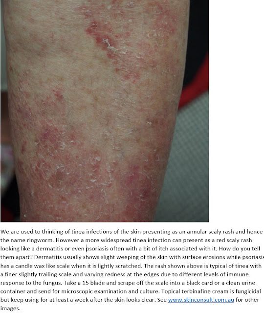Consultations in Dermatology: Tinea scale