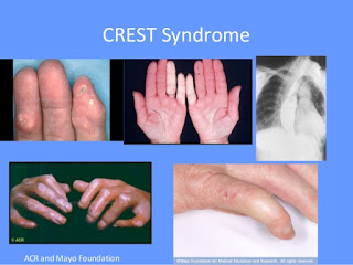 krok 2 (Rheumatology) with explanation part 6
