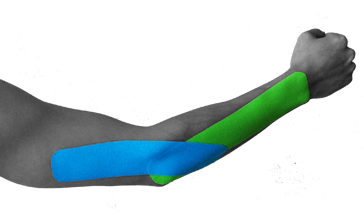 ARES Kinesiology Tape: Arestape Applications - Lateral Elbow Pain 1
