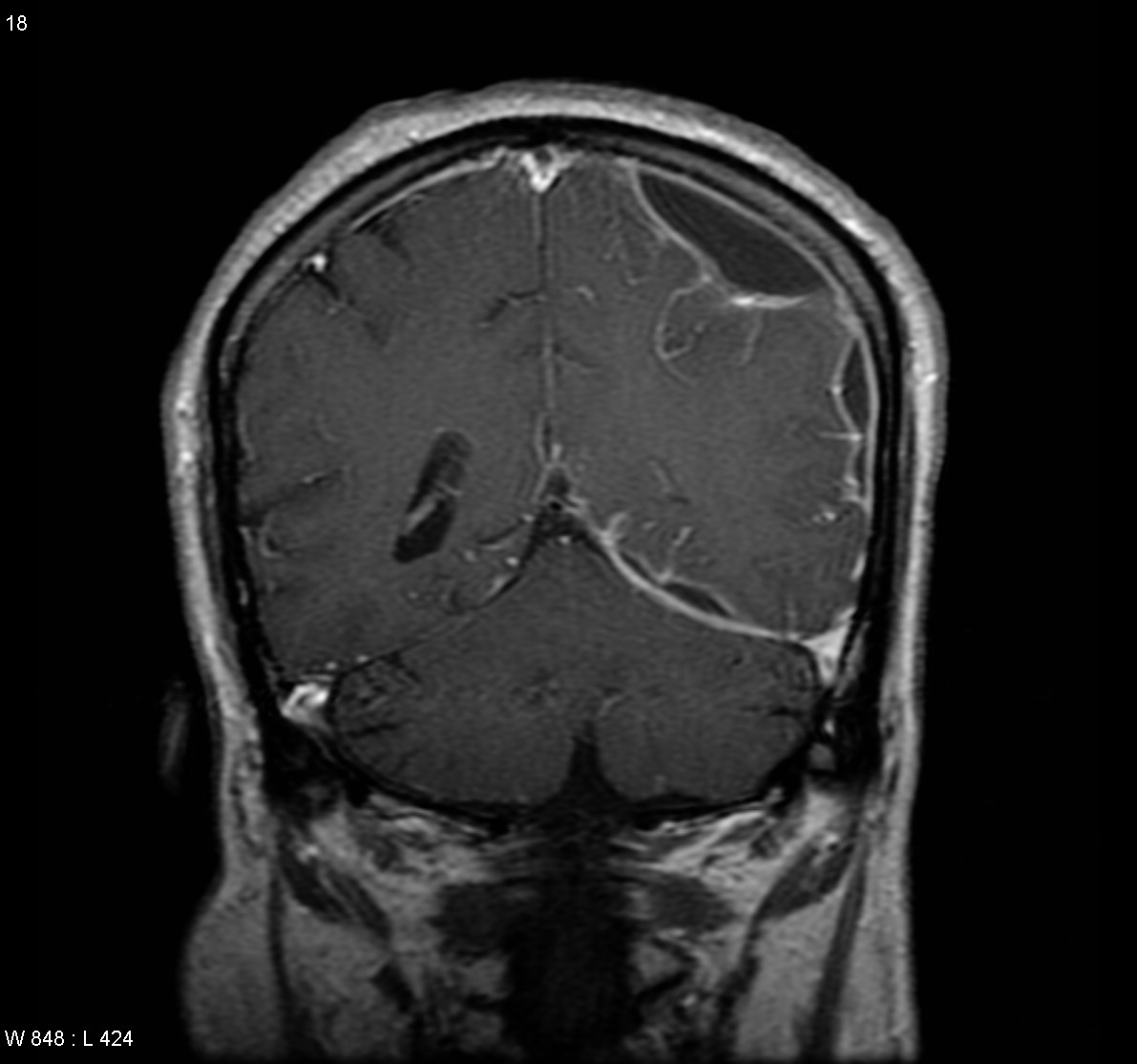 subdural abscess - meddic