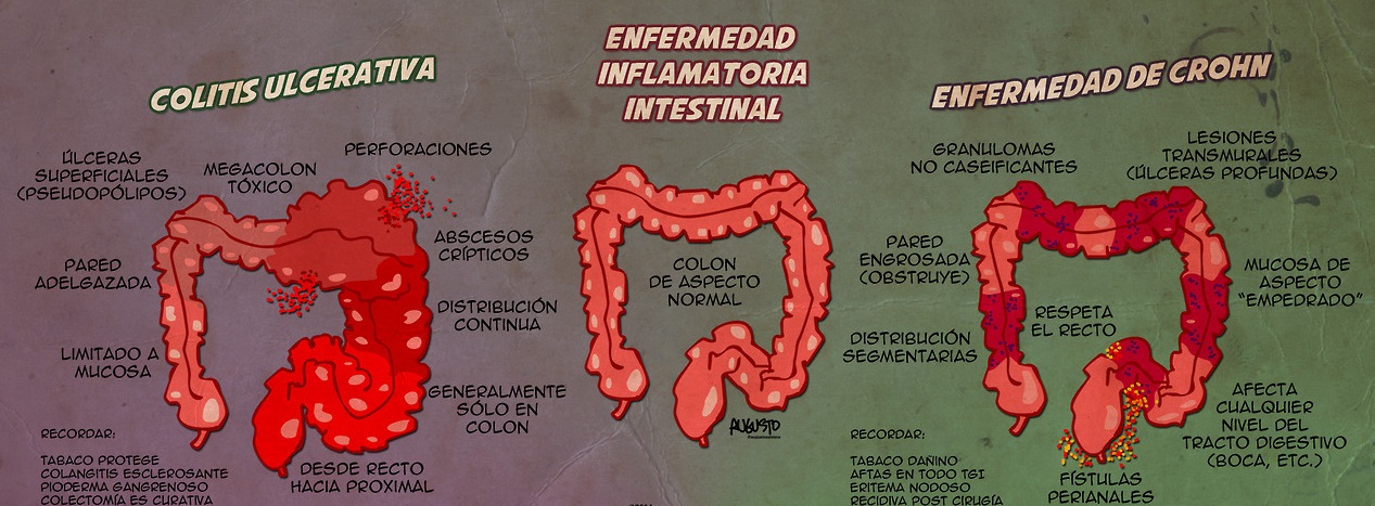 Fisiopatología Humana: Inflamaciones intestinales crónicas