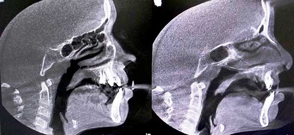 Z-Plasty-Revision Surgery - Richardson dental and craniofacial ...