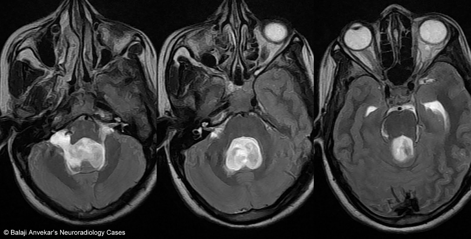 Dr Balaji Anvekar FRCR: Intraventricular Arachnoid cyst MRI