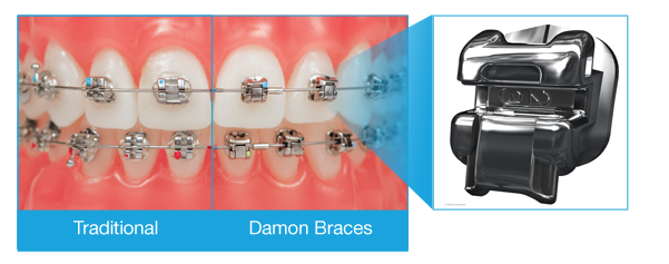 Poser Orthodontics Blog: What is the Damon System?