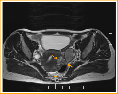 Endometriosis-MRI - Sumer's Radiology Blog