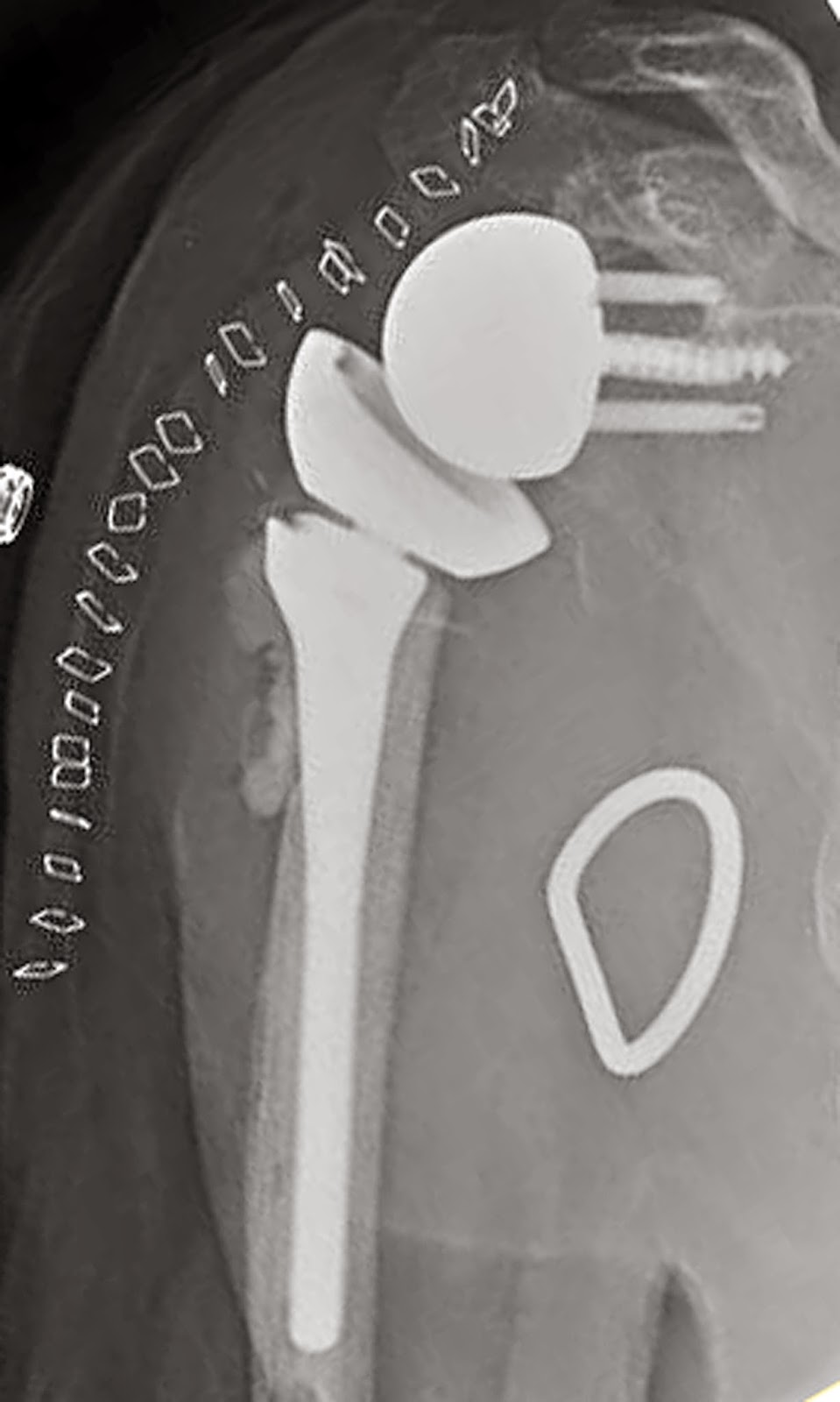 UW Shoulder and Elbow Academy: Reverse total shoulder joint replacement ...