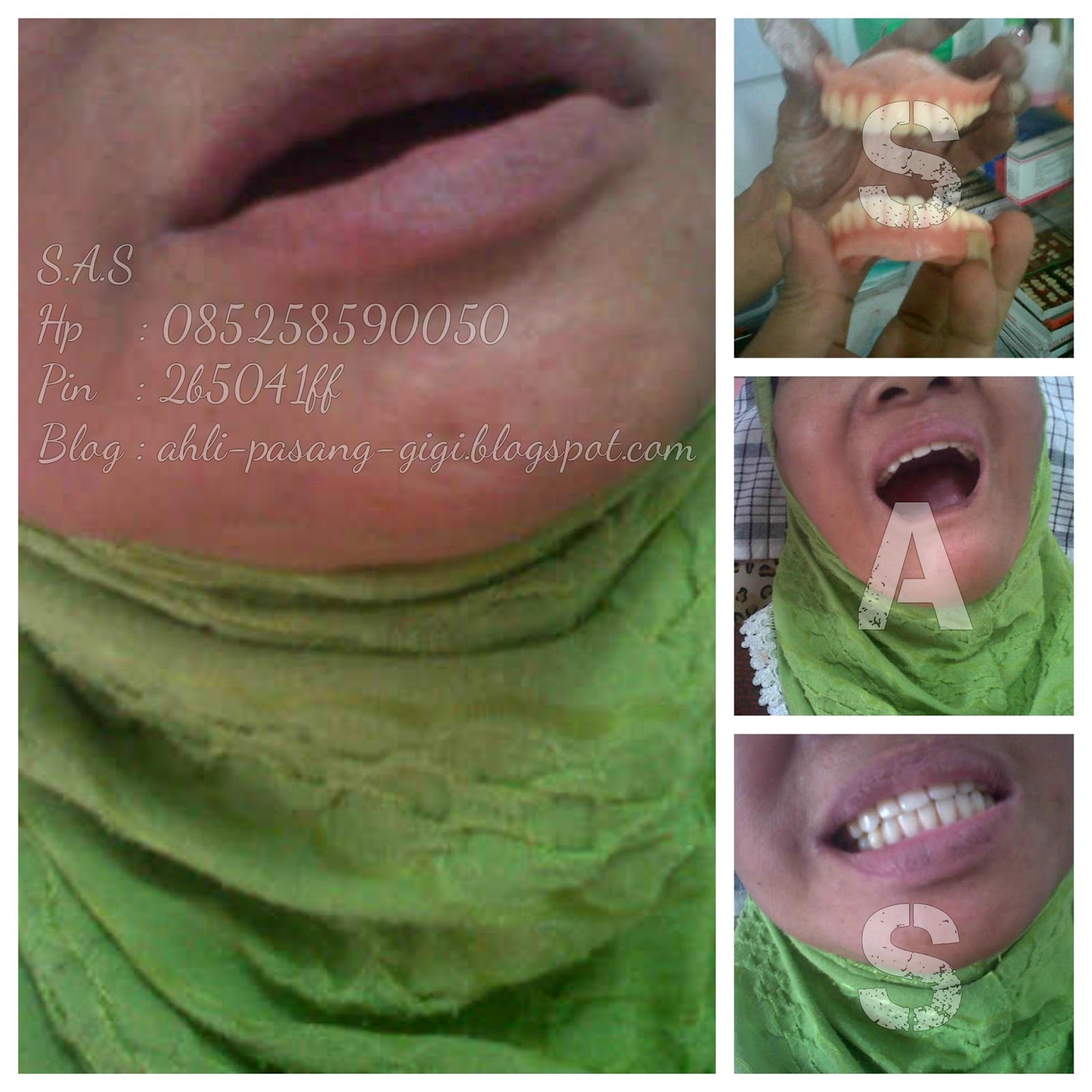 Contoh-contoh Gigi Palsu Lepas Pasang (New Photo) | S.A.S Dental