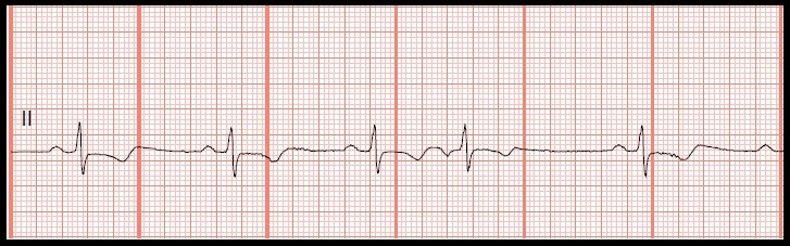 Practice EKG Rhythm Strips 118