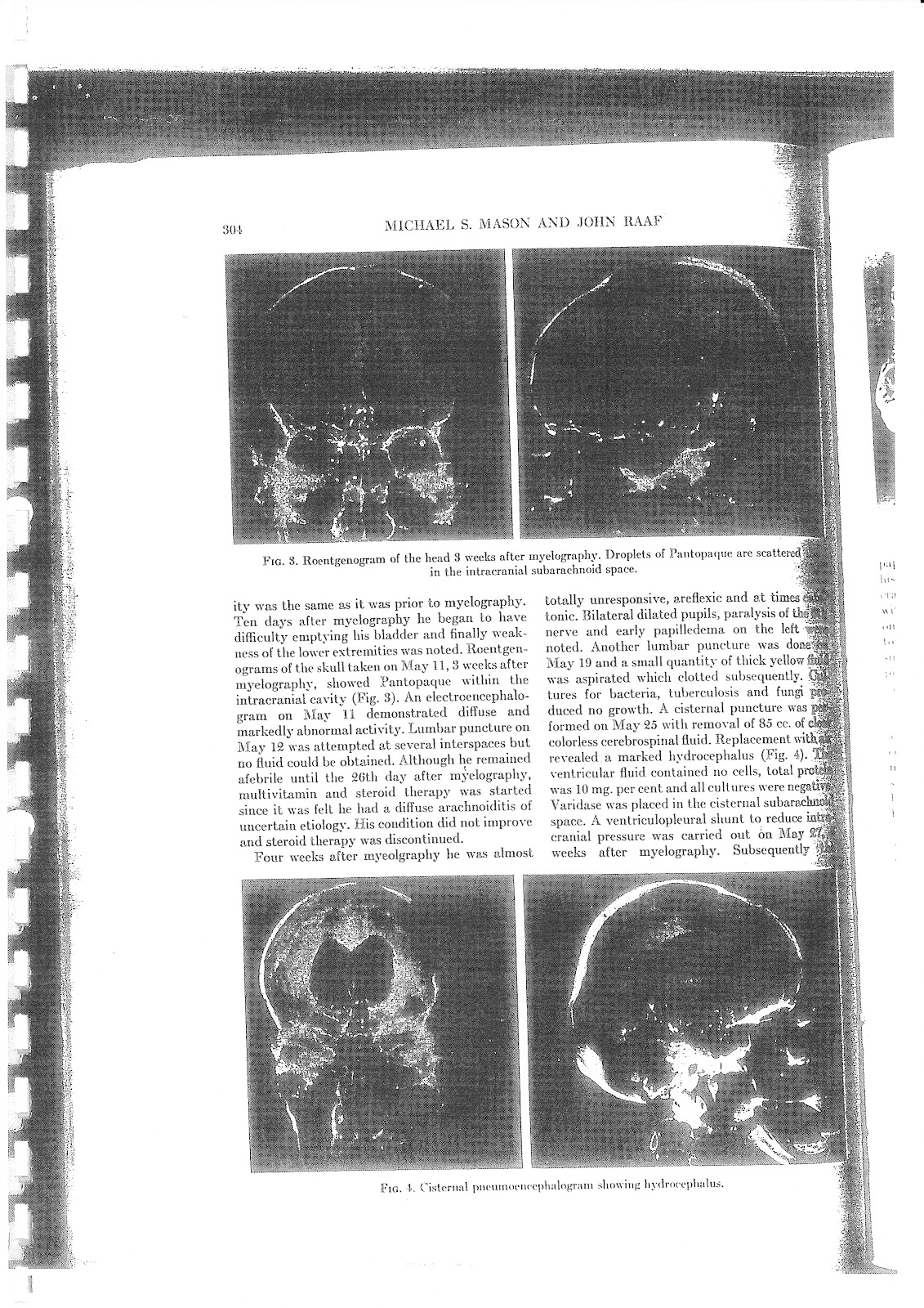 Myelogram Killer: 6. 3-Pantopaque, 1-Myodil Medical Murder Cases