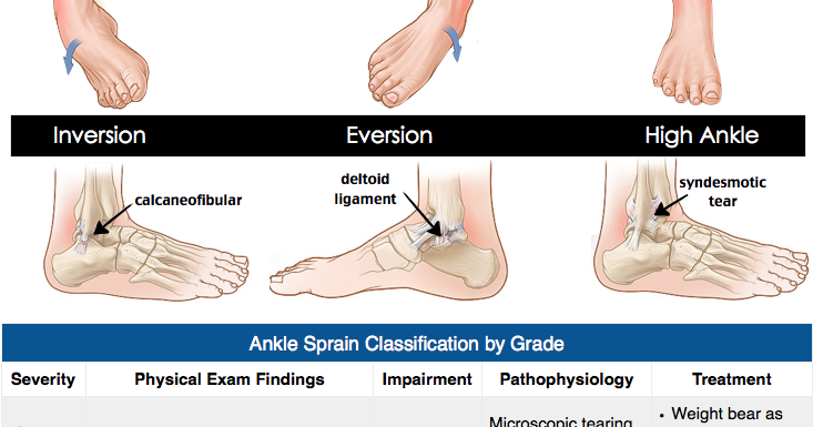 Penyebab, Tujuan Penanganan dan Penanganan di Rumah Cidera Engkel atau ...