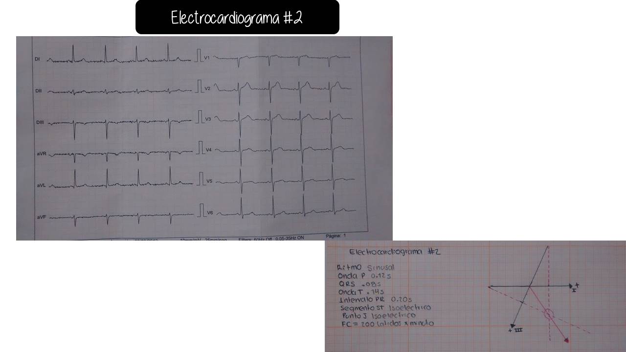FISIOLOGÍA BÁSICA: Electrocardiograma (Interpretación, Eje Eléctrico)
