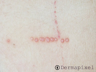 Dermapixel: abril 2011