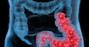 Constipatie (verstopping, obstipatie)