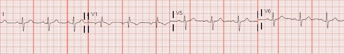 Bundle Branch Block Quiz Part 3