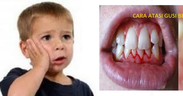 Obat Gejala Radang Gusi Bengkak Pada Anak Herbal Terbaik | Obat Keloid ...