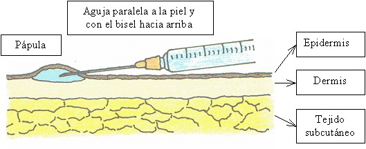 Lo fundamental de enfermería.: Vía intradérmica