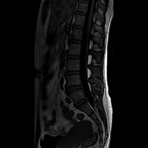 MRI Vertebrae Lumbar In Patient low back pain - Radiology Imaging