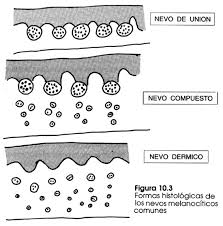 Alteraciones bucales: Nevo pigmentado oral
