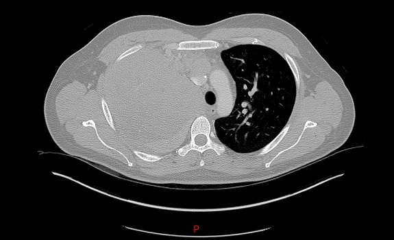 Roberto Fights Cancer!: New CT scan and PICC dressing cleaning