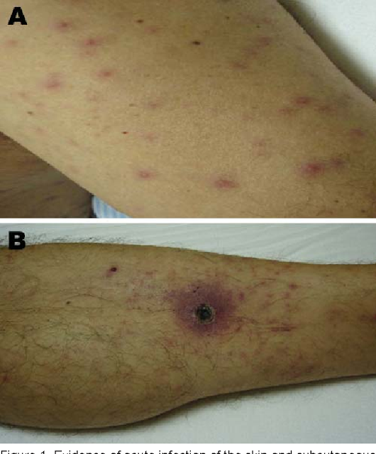 What Is Typhus? - Teroes