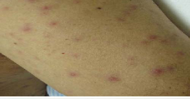 What Is Typhus? - Teroes