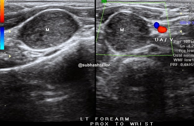 SONO DIGEST: ULTRASOUND EVALUATION OF FOREARM ULNAR NERVE SCHWANNOMA