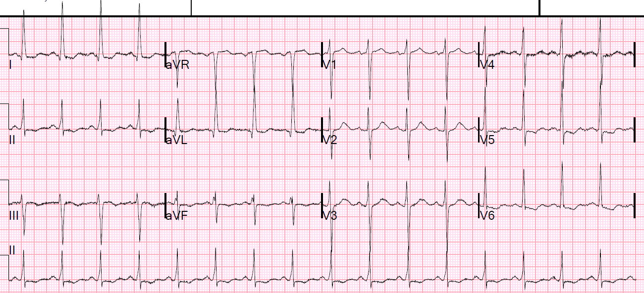 Dr. Smith's ECG Blog: Diffuse ST depression, and ST elevation in aVR ...