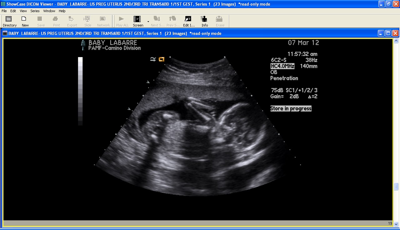Golden Gate Fam: 19 Week Ultrasound