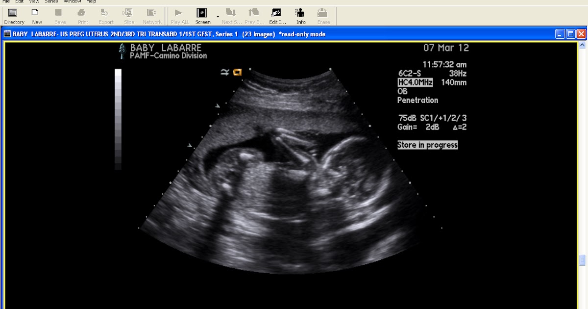 Golden Gate Fam: 19 Week Ultrasound