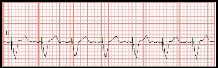 Practice EKG Rhythm Strips 118