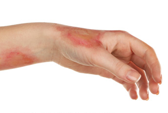 MarMedika: Jenis-Jenis Derajat Luka Bakar