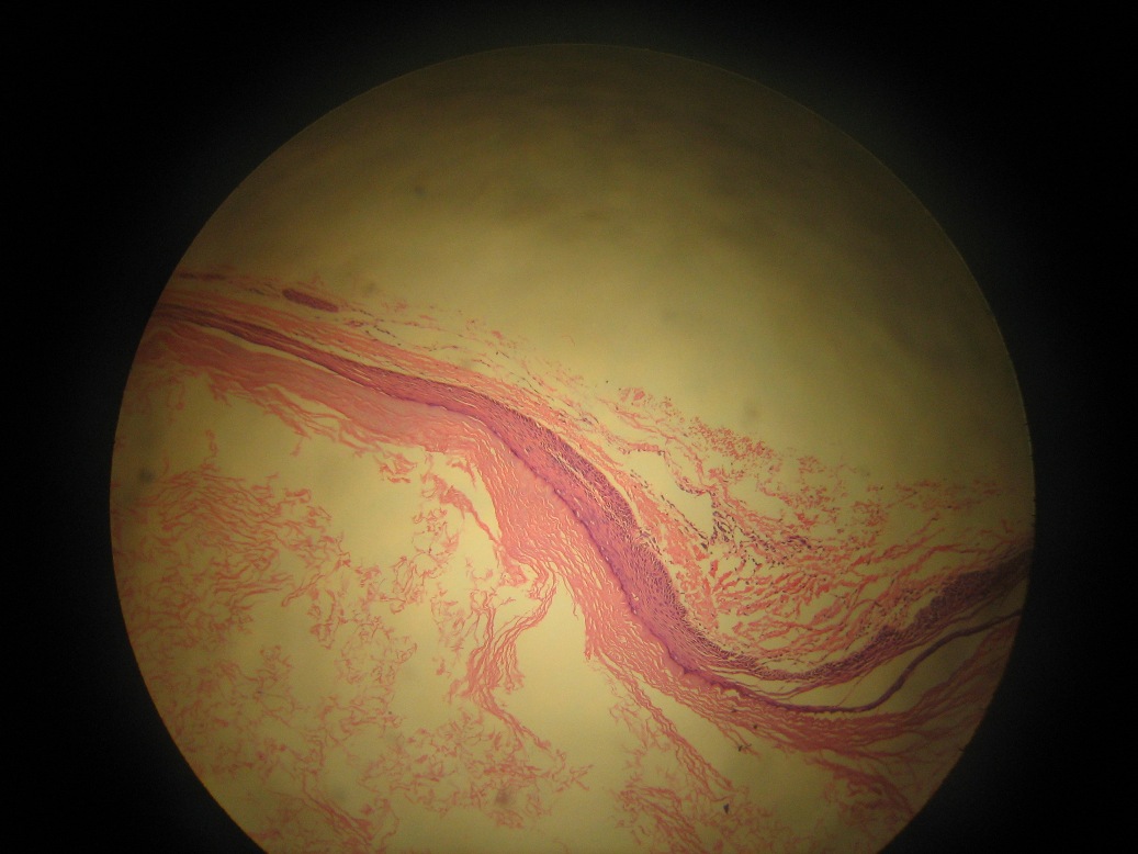 Dentistry and Medicine: Cysts in the mouth and jaws with histologic Slides