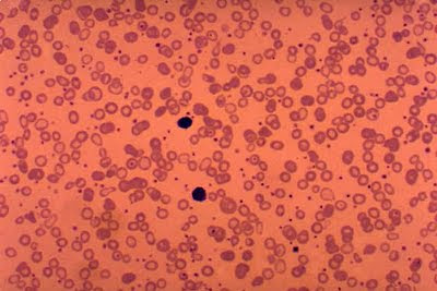 Iron deficiency anemia - Microcytic hypochromic cells